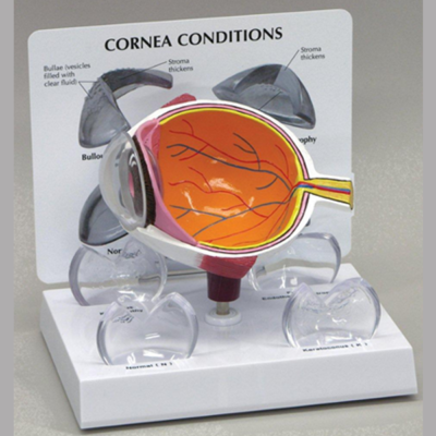 Eye model with cornea condition - Aceconcepts